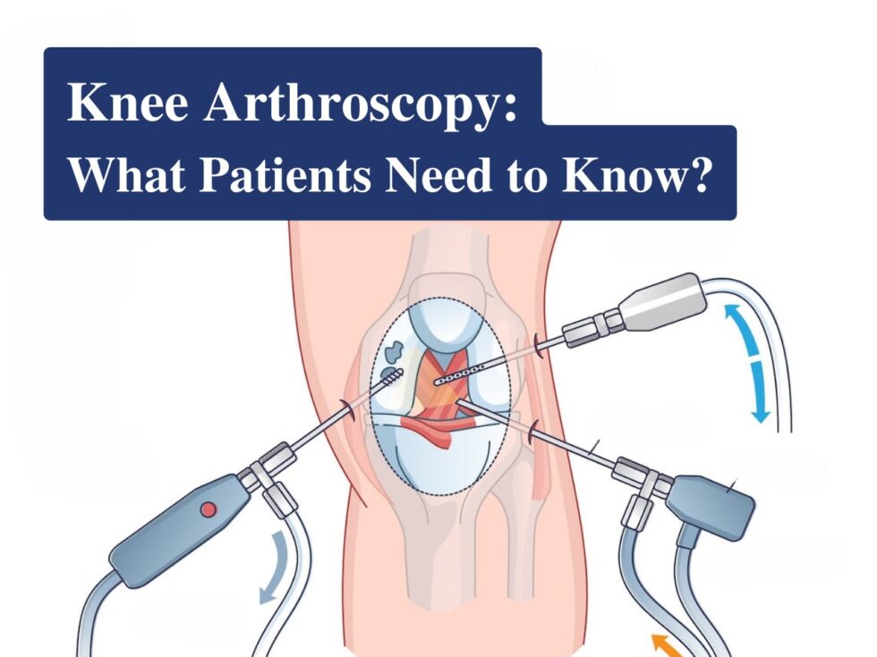 How to Prepare for Arthroscopic Knee Surgery? | Expert Tips